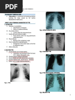 Pneumothorax Size Estimation Guide | PDF | Medicine | Clinical Medicine
