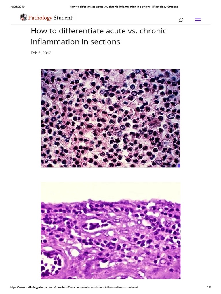 How To Differentiate Acute vs. Chronic Inflammation in Sections ...