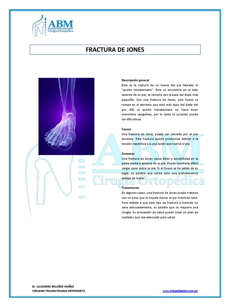 Fractura de Jones | PDF | Pie | Hueso
