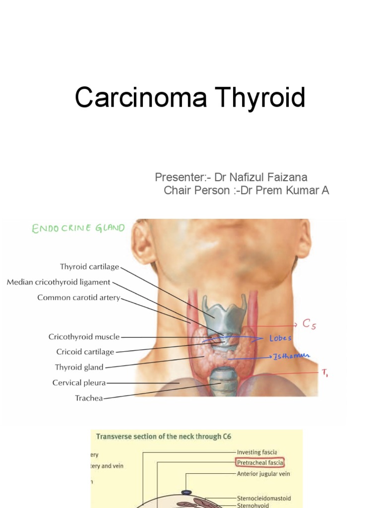 Ca Thyroid | PDF