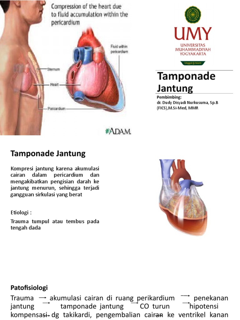 Tamponade Jantung | PDF