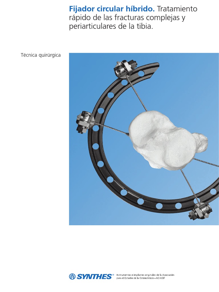 Fijador Circular Hibrido | PDF | Tornillo | Rodilla