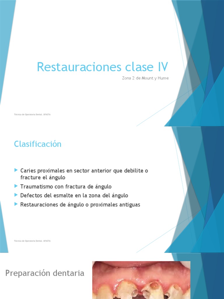 Restauraciones Clase IV | PDF | Compuesto Dental | Diente