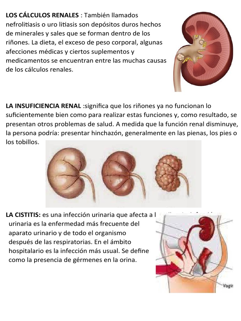 Los Cálculos Renales | PDF
