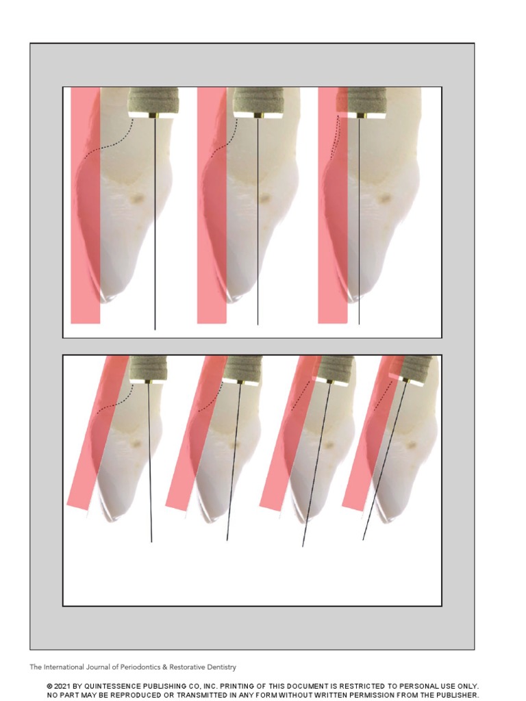 3D Implant Position Esquivel 2021 | PDF | Dental Implant | Dentistry ...