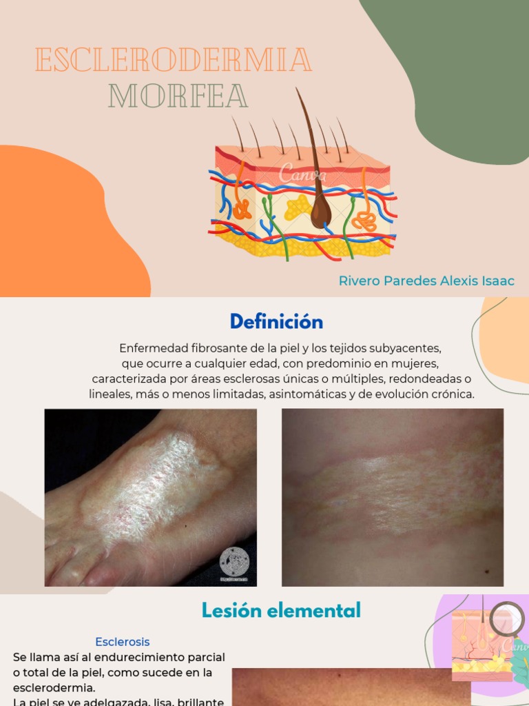 Esclerodermia y Morfea | PDF | Especialidades Medicas | Ciencias de la ...