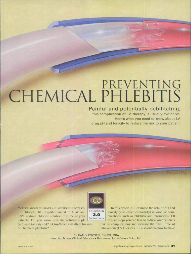 Preventing Chemical Phlebitis | PDF | Intravenous Therapy | Saline ...
