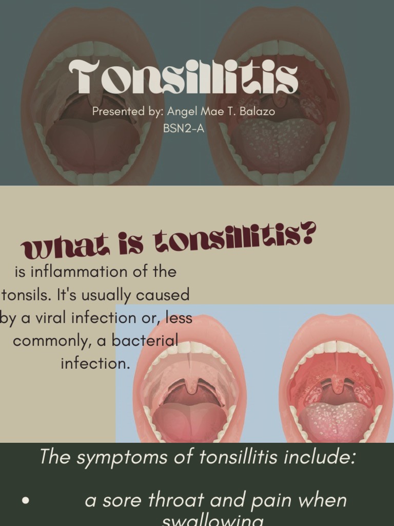 Tonsillitis and Epistaxis | PDF | Human Nose | Immunology