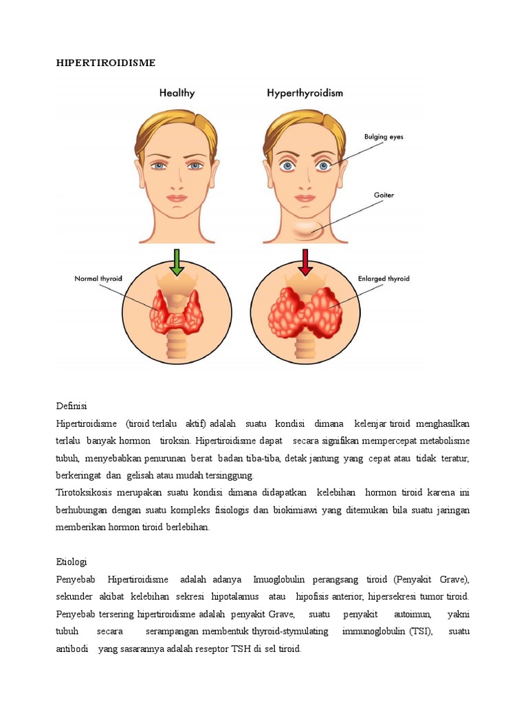 Ciri dan Etiologi Hipertiroidisme | PDF