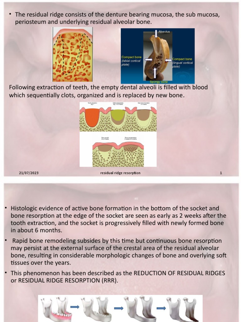 Residual Ridge Resorption Overview | PDF | Dentures | Dental Implant