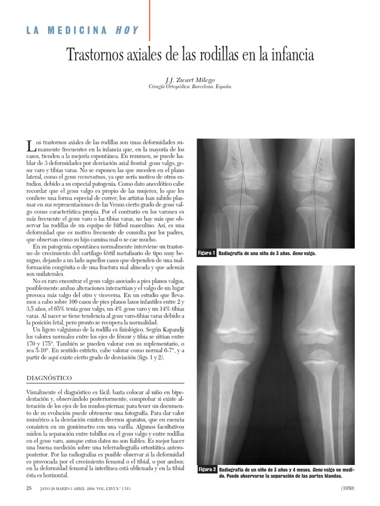 Genu Varo | PDF | Rodilla | Sistema musculoesquelético
