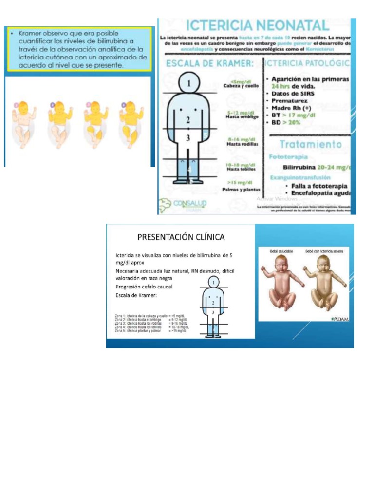 ictericia neonatal zonas kramer | PDF