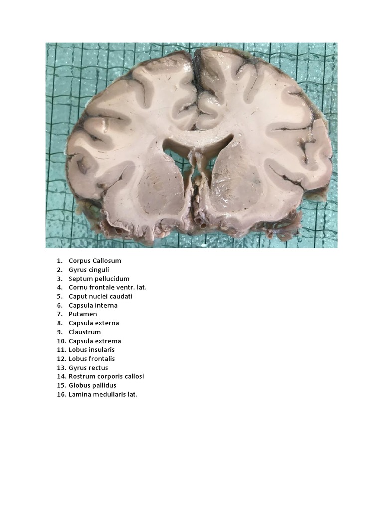 Brain Slides SEMINAR 1 - 220606 - 142811 - 220606 - 223805 | PDF ...