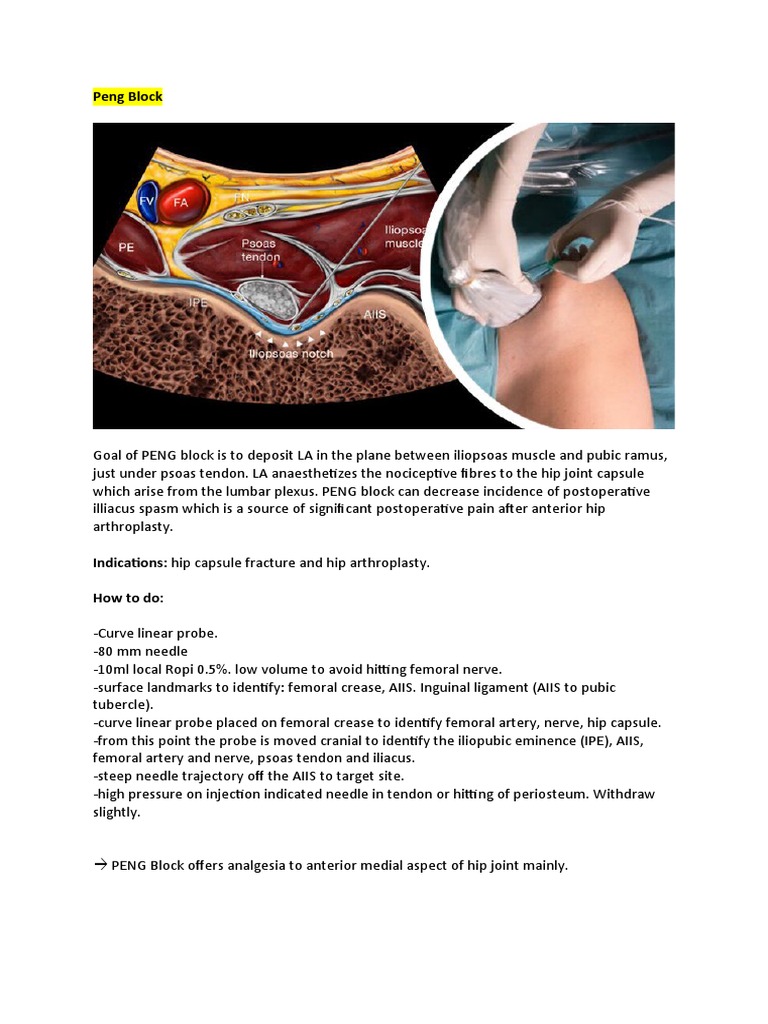 PENG Block for Hip Surgery | PDF