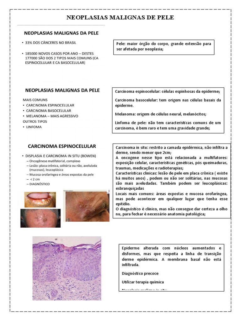 4-Neoplasias Malignas de Pele | PDF | Carcinoma | Pele