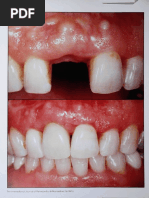 Miller Classification of Tissue Recession | PDF | Periodontology ...