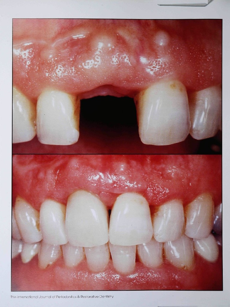 Reconstruction of The Lost Interproximal Papilla - Presentation of ...
