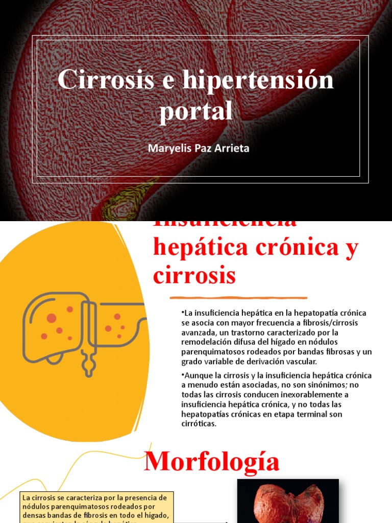 Paz Maryelis Cirrosis e Hipertensión Portal | PDF | Cirrosis | Hipertensión