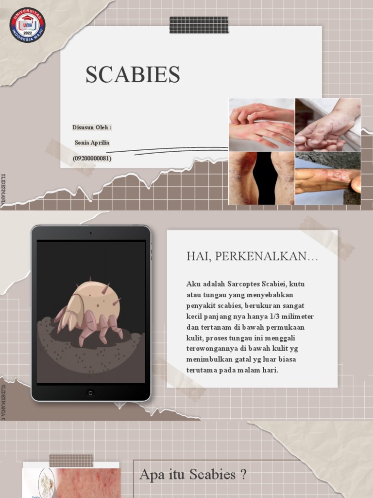 Sonia Aprilia-Ppt Scabies | PDF