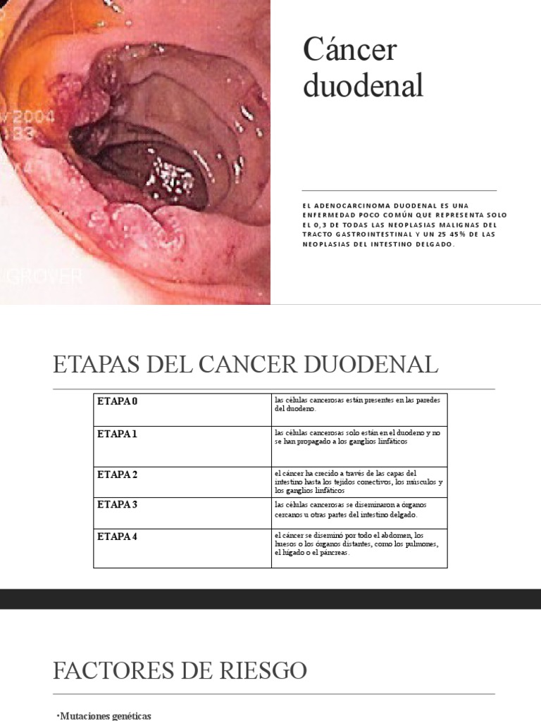 Cáncer Duodenal: Etapas y Tratamientos | PDF