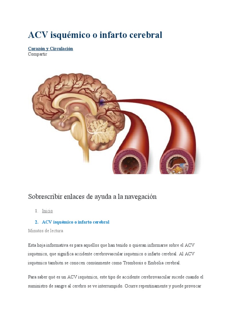 ACV Isquémico o Infarto Cerebral | PDF | Relaciones personales, crianza ...
