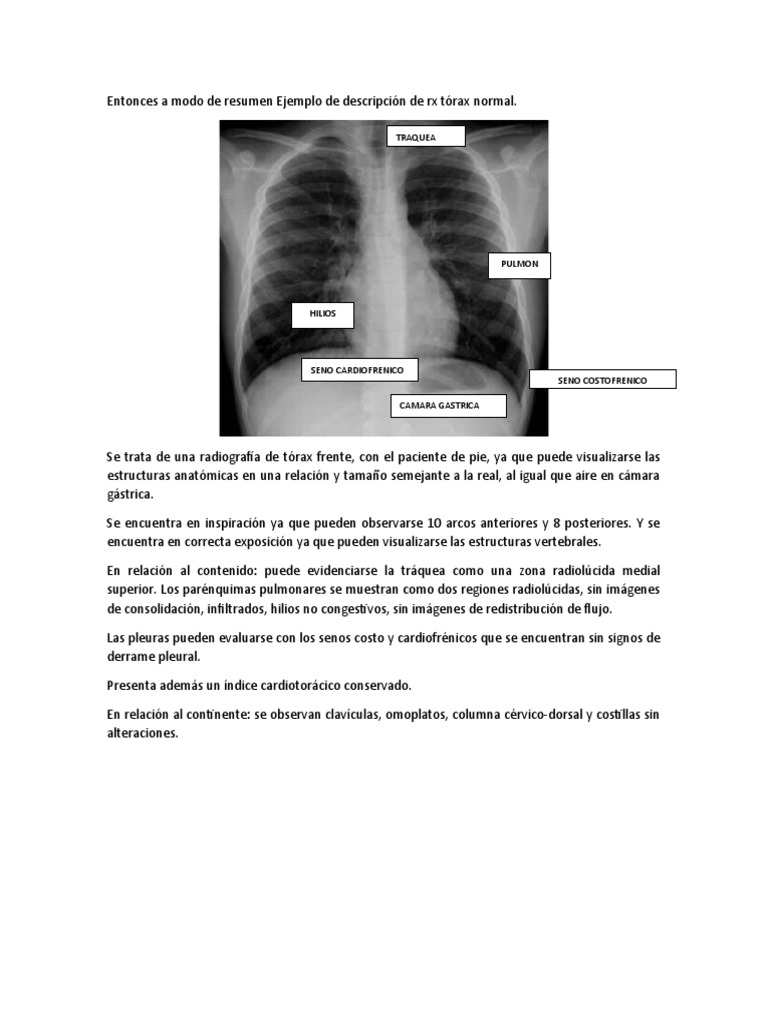 Ejemplo RX Torax Normal | PDF