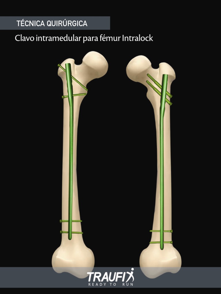 Clavo Intramedular para Fémur Intralock | PDF
