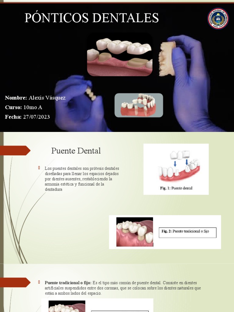 Póntico Dentales | PDF | Implante dental | Ramas de Odontología