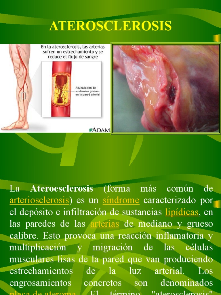 Diapo Aterosclerosis PP | PDF