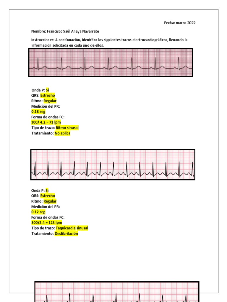 Trazos ECG | PDF