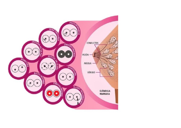 Cancer de Mama | PDF