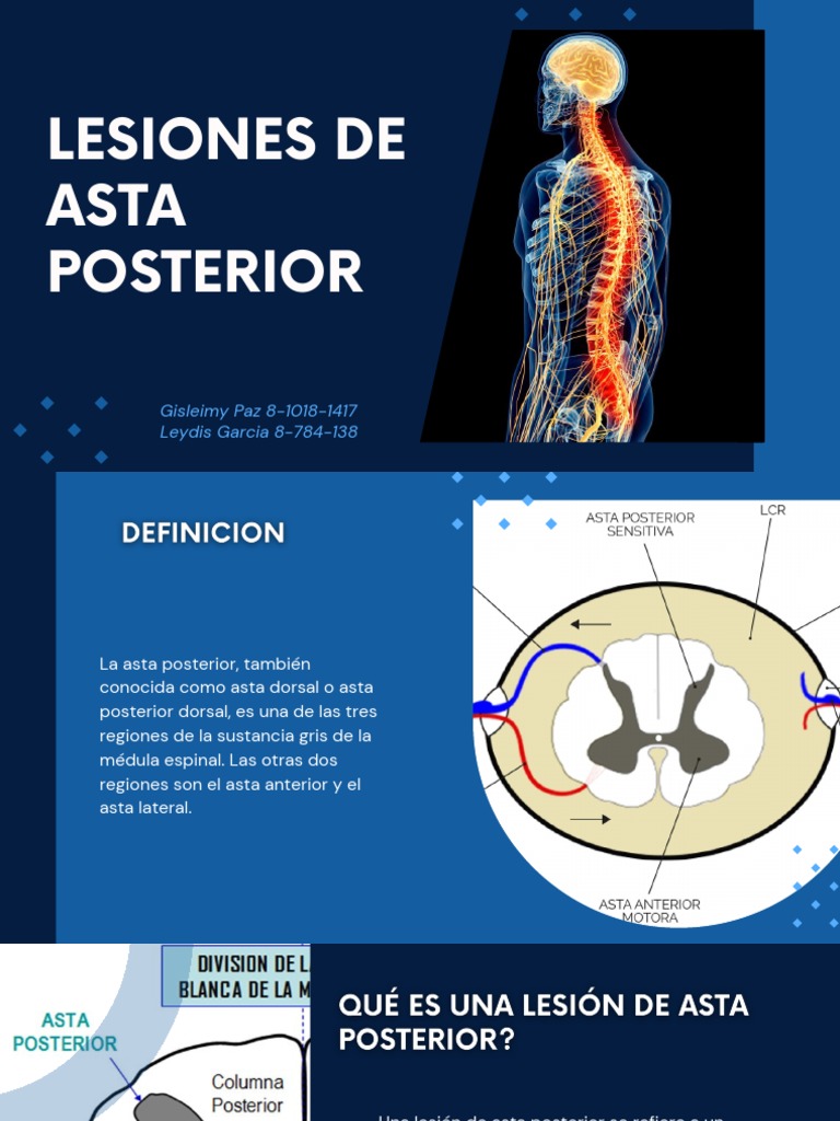 Lesiones de Asta Posterior | PDF