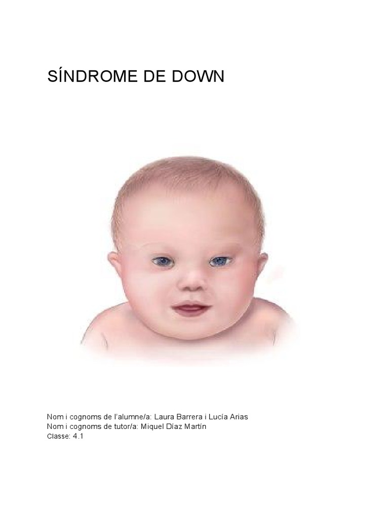 Sindrome de Down | PDF