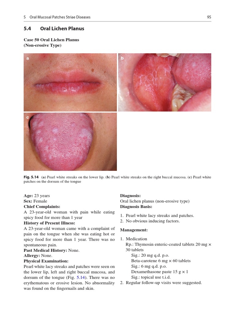 Case 50 Oral Lichen Planus (Non-Erosive Type) | Download Free PDF | Hematopoietic Stem Cell ...