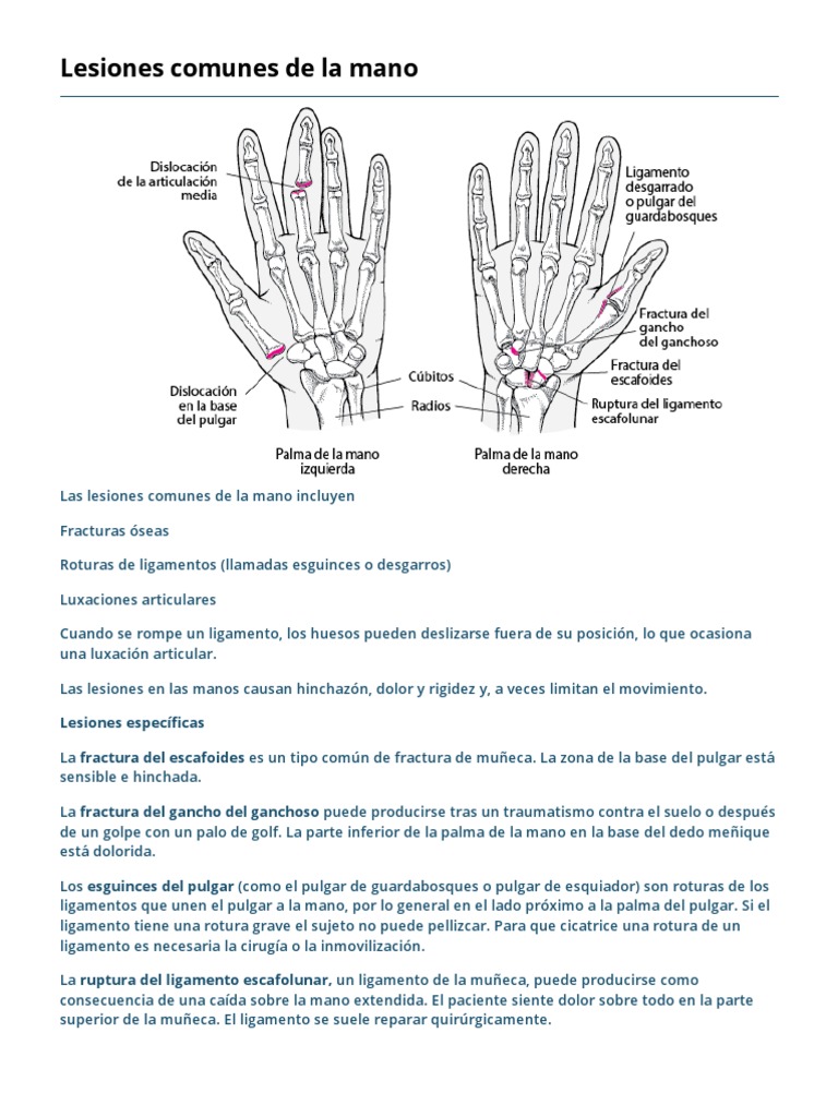 Fracturas de La Mano - Traumatismos y Envenenamientos - Manual MSD ...