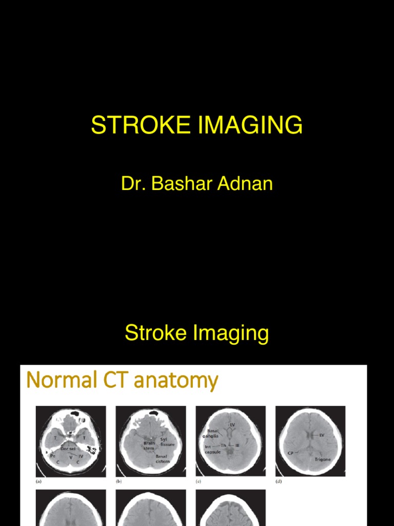 Stroke Imaging 1 | PDF | Wellness