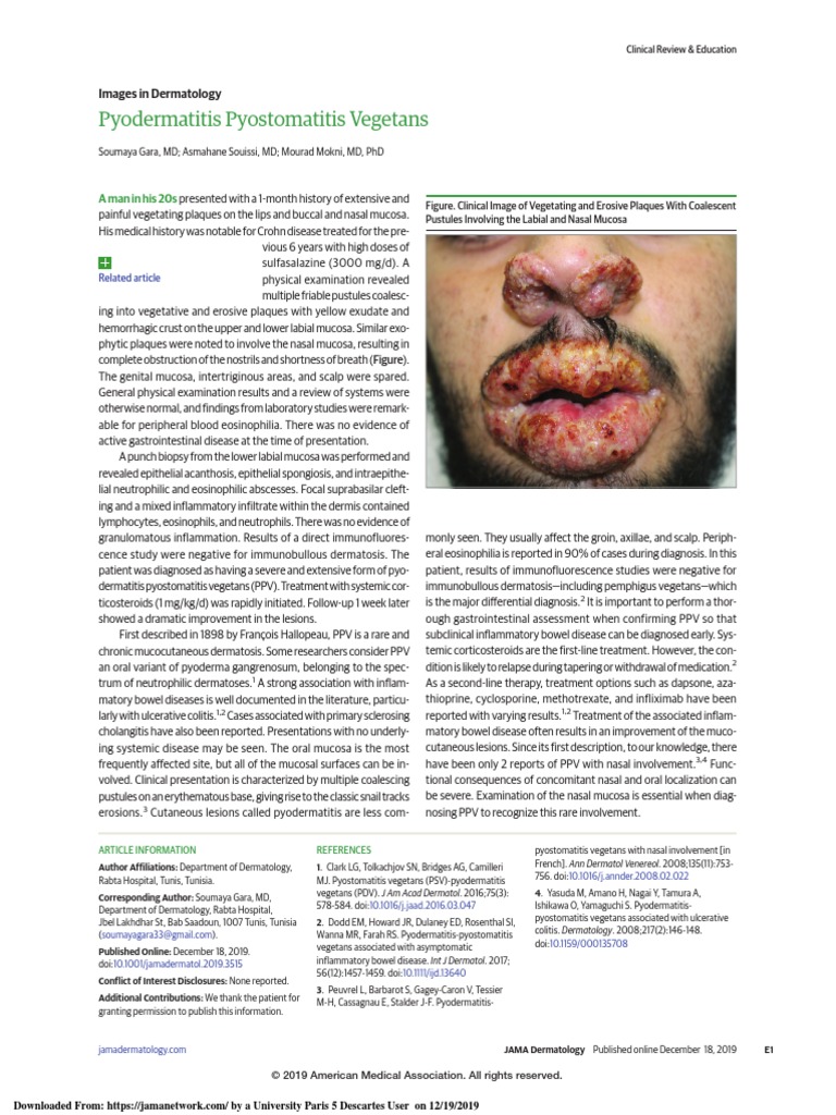 Hallopeau 10.1001@jamadermatol.2019.3515 | PDF | Ulcerative Colitis ...
