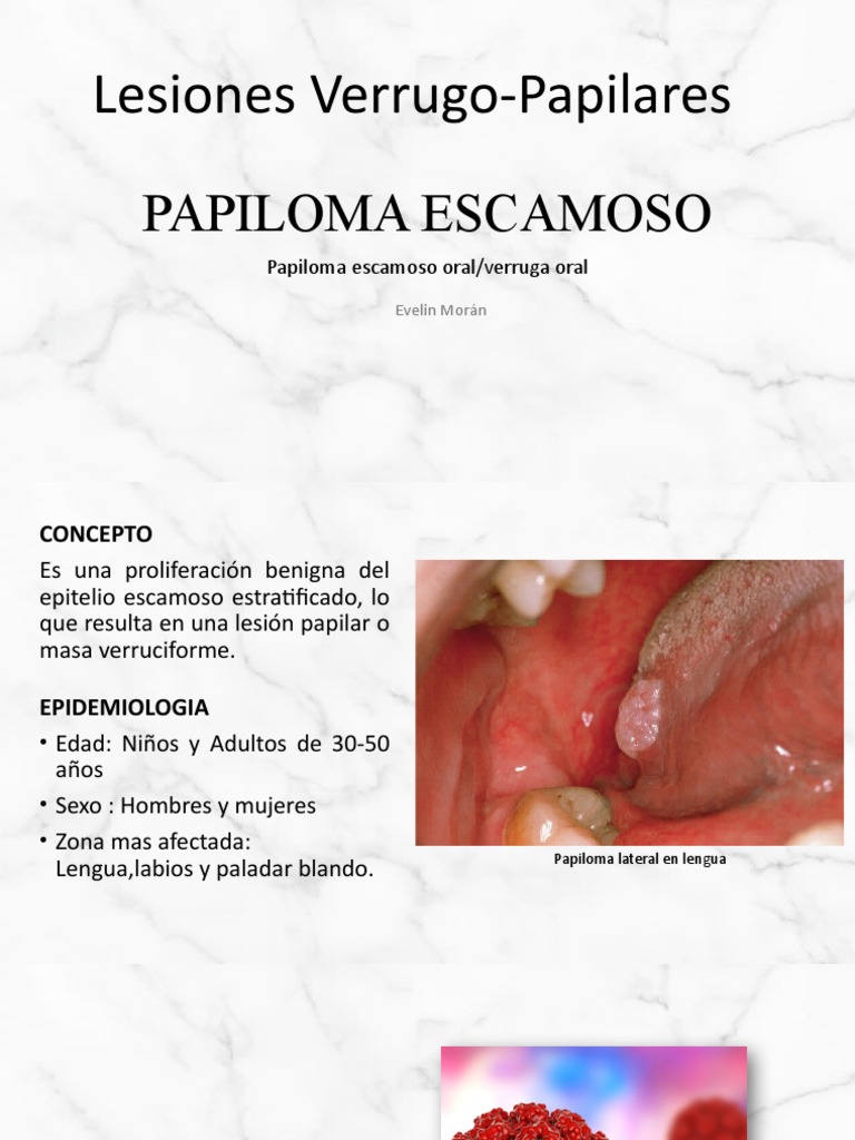 Papiloma Escamoso Oral | PDF
