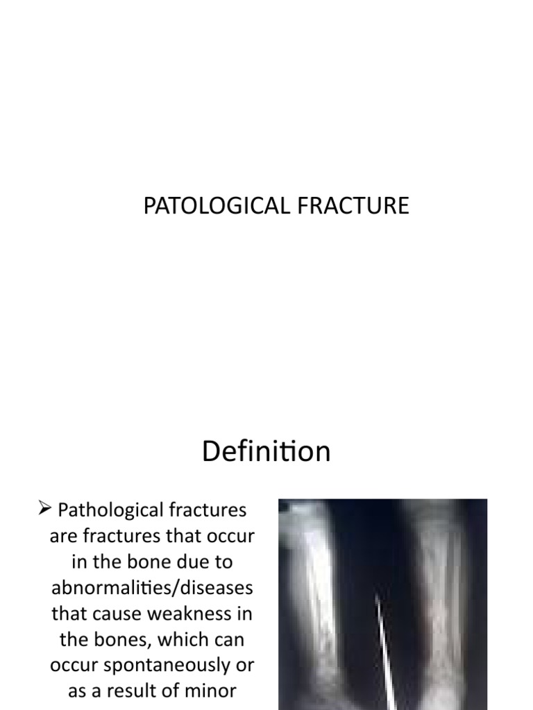Understanding Pathological Fractures | PDF | Bone | Pain