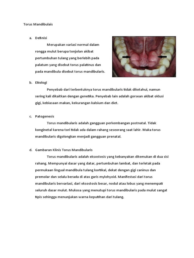 Torus Mandibulais | PDF