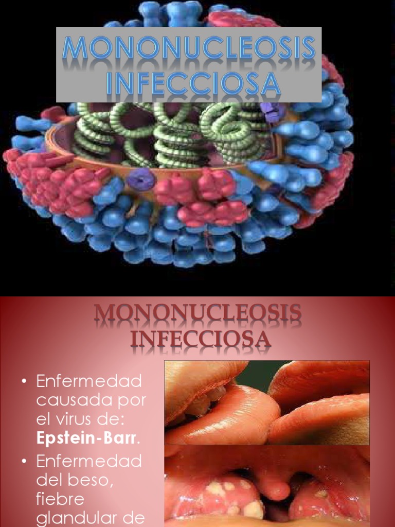 Mononucleosis Infecciosa: Causas y Síntomas | PDF | Medicina ...