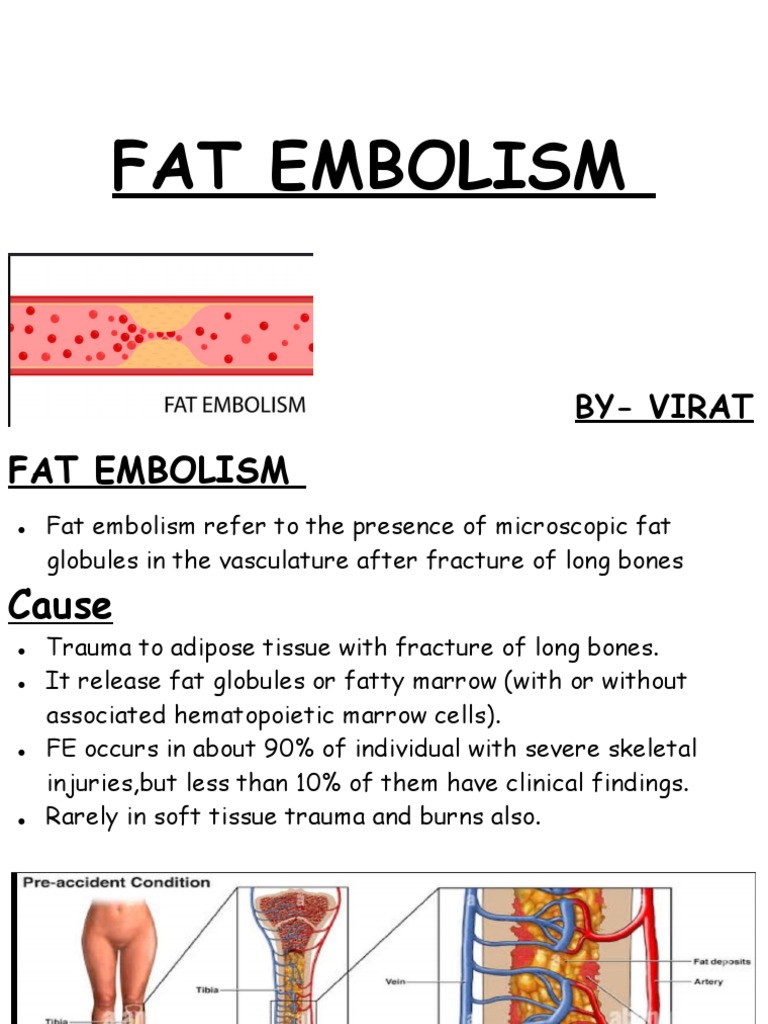 Fat Embolism | PDF