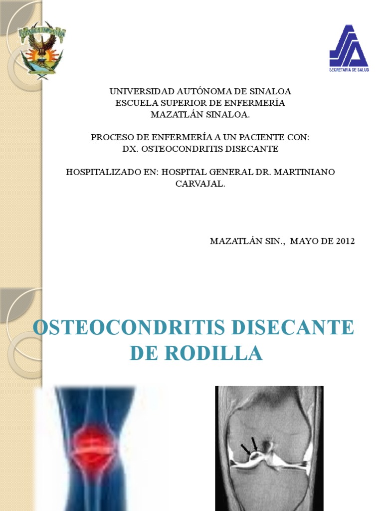 Proceso de Enfermería en Osteocondritis Disecante | PDF | Rodilla ...