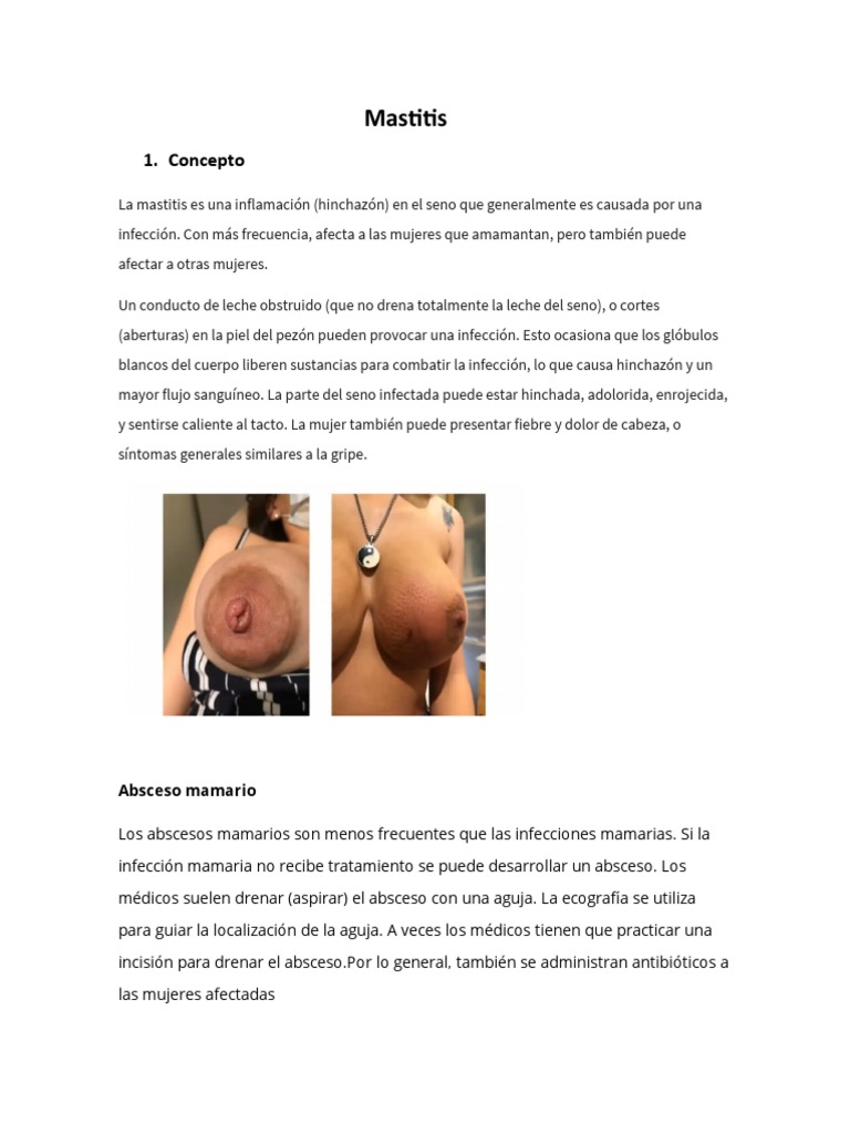 Mastitis 123 | PDF | Pecho | Cáncer de mama