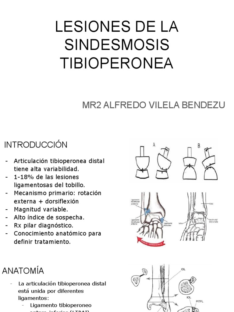 Lesiones Sindesmosis Tibioperonea | PDF