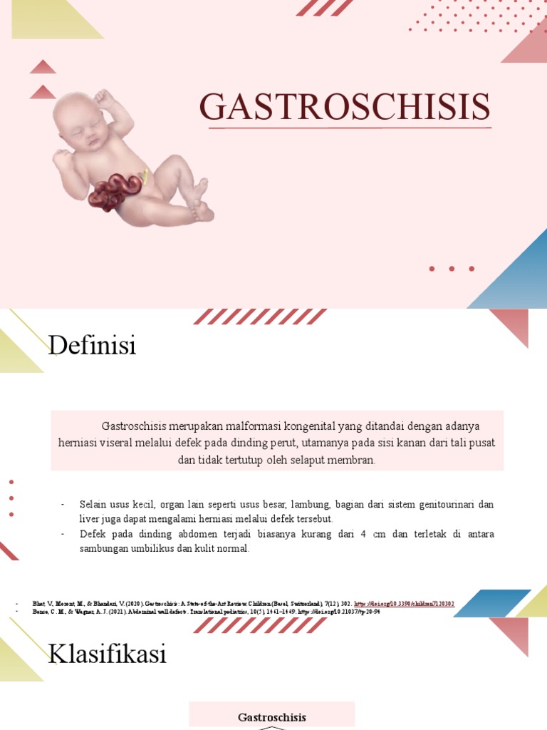 Gastroschisis | PDF