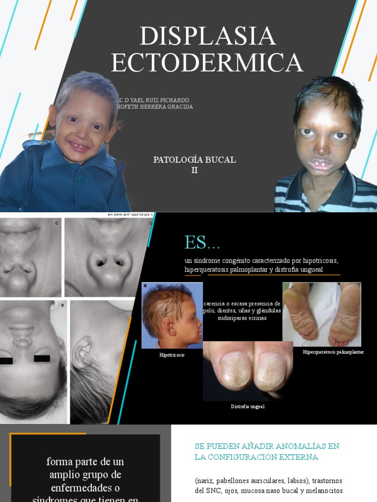 Displasia Ectodérmica: Diagnóstico y Tratamiento | PDF | Estudios de ...