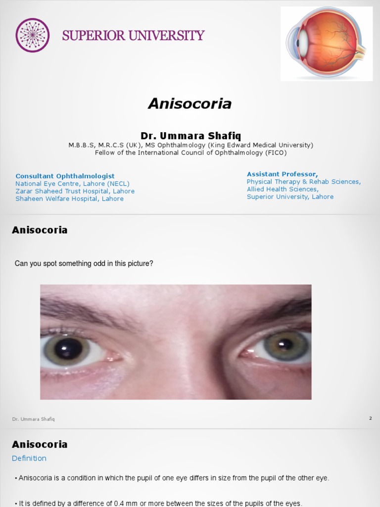 Anisocoria: Causes, Diagnosis, Treatment | PDF | Self-Improvement