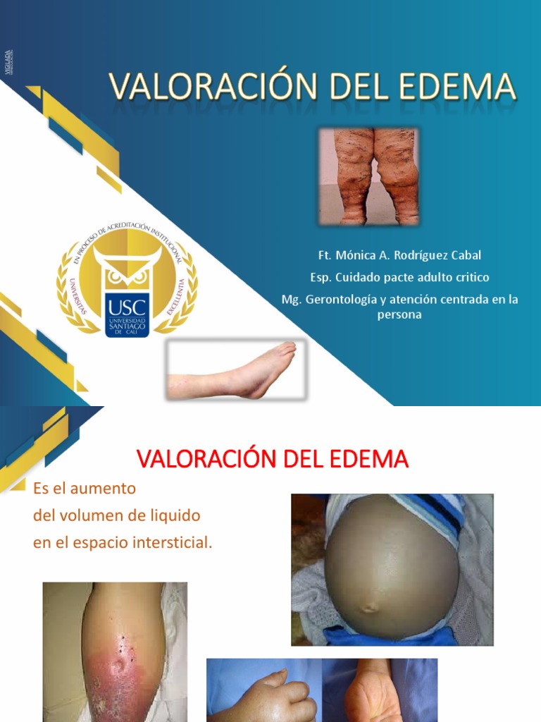 Tema 6 Edema | PDF