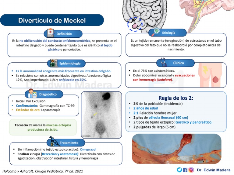 Divertículo de Meckel | PDF